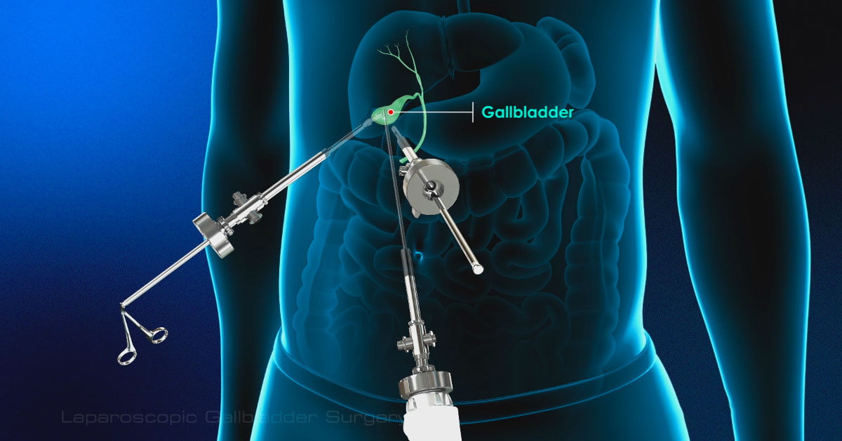 phac-do-dieu-tri-soi-tui-mat-an-toan-hieu-qua-nhat-2 - Sỏi Mật Trái Sung