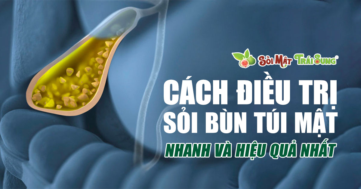 Cách điều trị sỏi bùn túi mật nhanh và hiệu quả nhất
